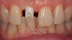 Frontzahnimplantate: Ein Lächeln wiederherstellen