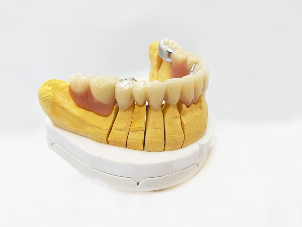 Hochwertige Zahnprothesen: wie eine abnehmbare Brücke