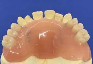 Einfache herausnehmbare Prothesen - implantate.info